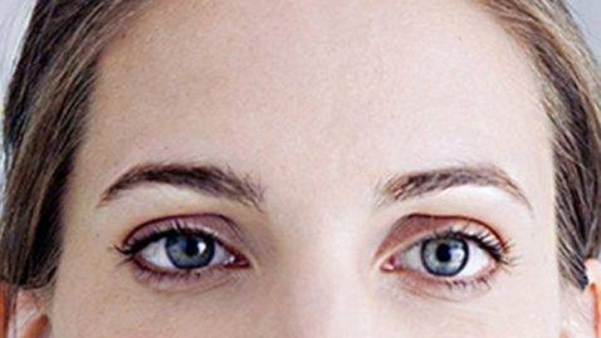 Ambliopía, conocida como ojo perezoso u ojo vago